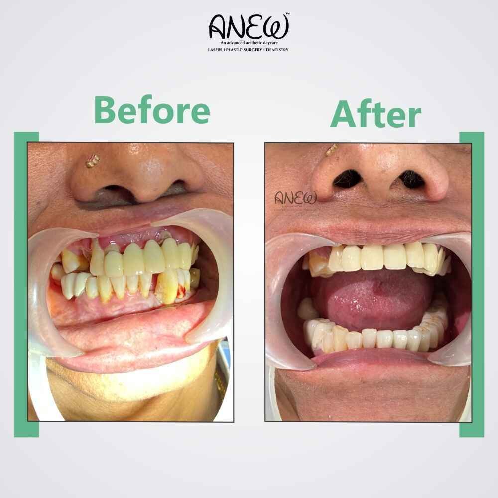 Best Dental Implants In Bangalore - Anew Cosmetic Clinic